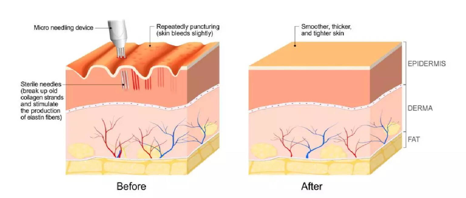 Microneedling Treatment in Welwyn Garden City | Silk & Dew Clinic